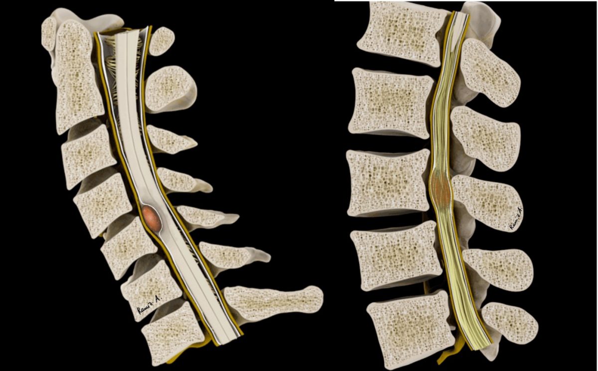 omurga tümörleri cerrahisi | Prof. Dr. Kenan KOÇ :: Beyin, Omurilik ve ...