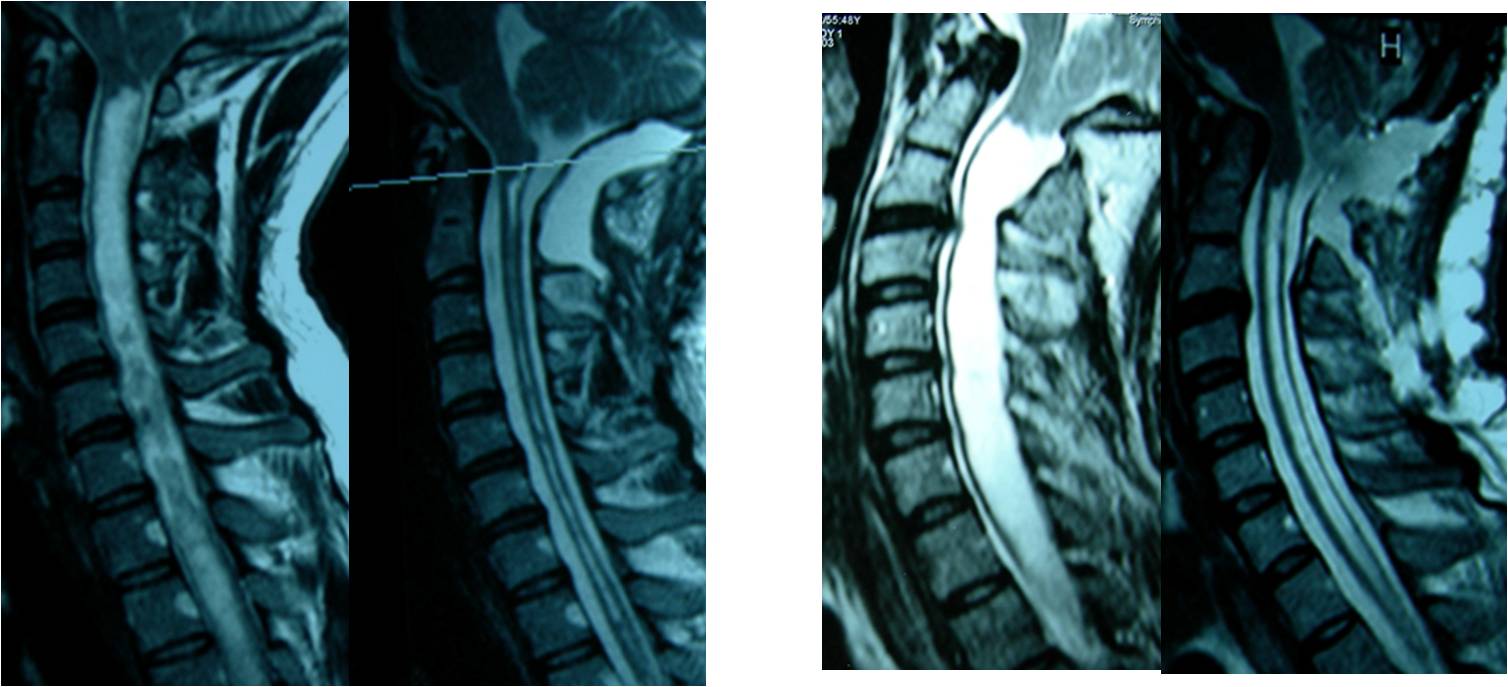 hidromyeli | Prof. Dr. Kenan KOÇ :: Beyin, Omurilik ve Sinir Cerrahisi ...